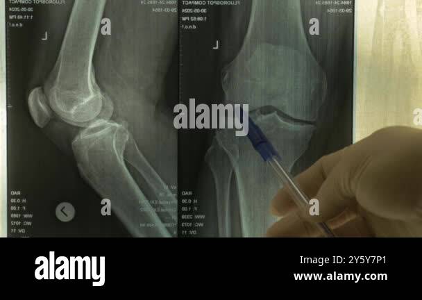 A doctor shows a problem in a patient's knee joint on an x-ray. X-rays ...