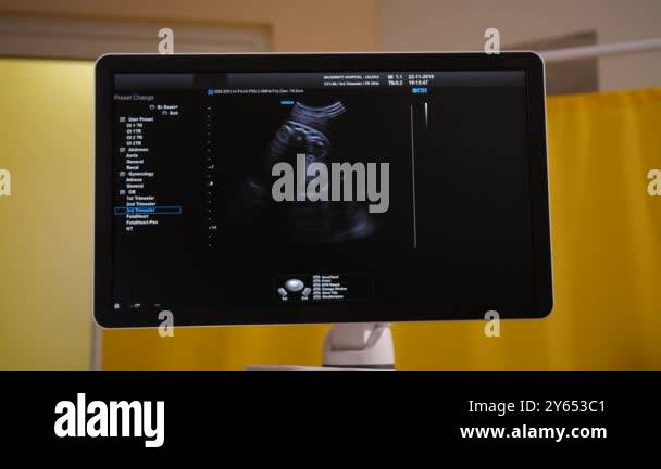 ultrasound screen with sonen. ultrasound for ultrasound in the clinic ...