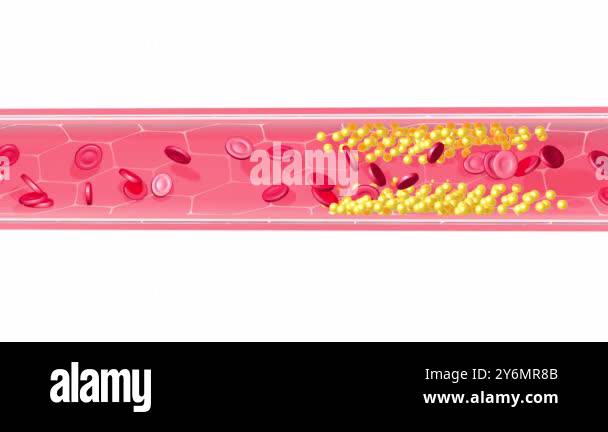 Anatomical 3D animation of the interior of an artery clogged by fat ...