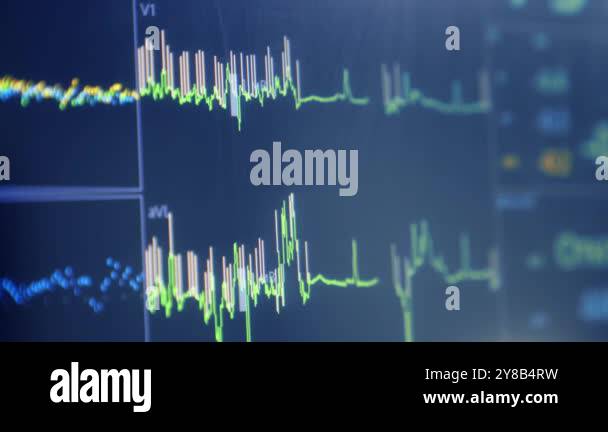 Wavy lines running on the medical monitor. Respiratory wave and ECG ...