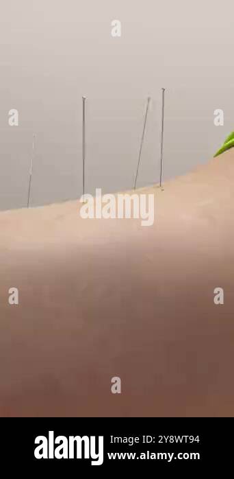 Acupressure needle medicine acupuncture Stock Videos & Footage - HD and ...