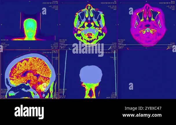 Magnetic resonance images of the head, MRI of the brain,top viev of a ...