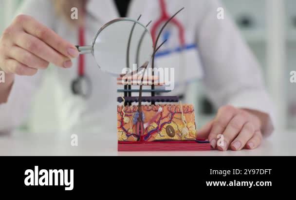 Model of human skin with a magnifying glass in clinic. Hair loss ...