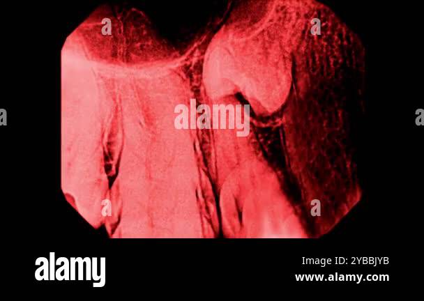 Stop motion of human teeth x-ray or ct scan horror collection. Human ...