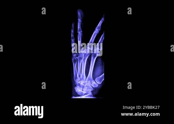 Animation loop of x ray human hand palm scan, timelapse of monochrome x ...