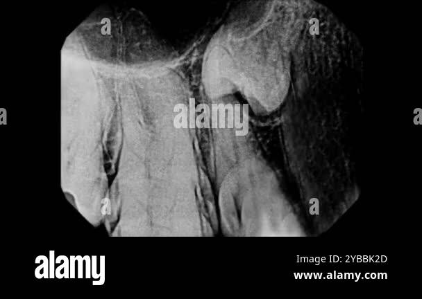 Stop motion video of human teeth X-Ray image. Teeth fillings scan and ...