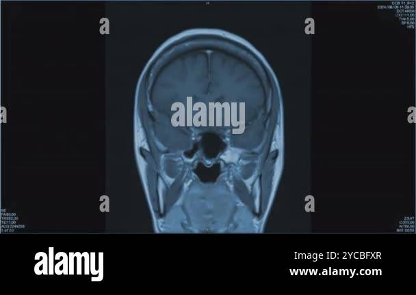 Magnetic resonance images of the brain, MRI of the brain, of a patient ...