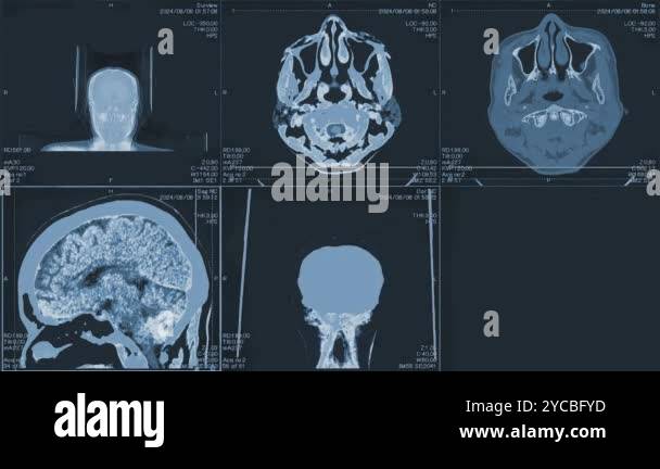 Magnetic resonance images of the brain, MRI of the brain, front and ...