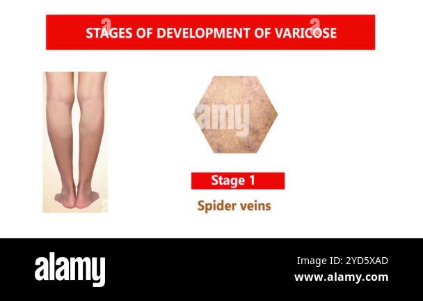 Varicose veins on a female senior legs. The stages of varicose veins ...