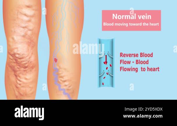 Deep Vein Thrombosis or Blood Clots. Embolus. Structure of normal and ...