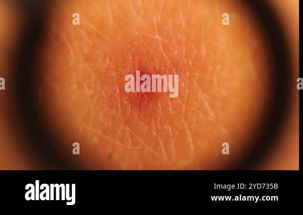 Stung by a Yellowjacket (wasp worker) after 2 minutes in the arm. After ...