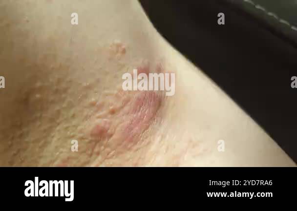 ringworm eczema infected on human body red rash ring on skin close up ...