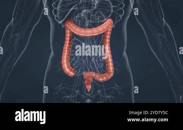 The large intestine includes the cecum, ascending colon, transverse ...