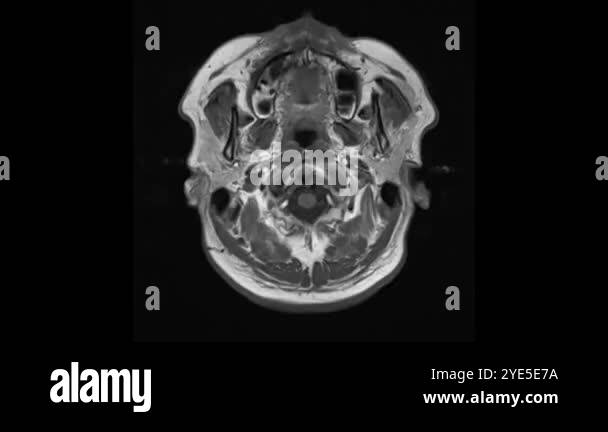 Axial T1-weighted magnetic resonance imaging (MRI) scan of a normal ...