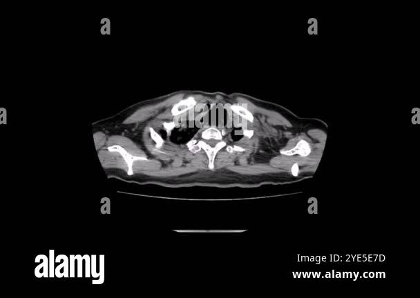 Computed tomography (CT) scan moving from the top to the bottom of the ...