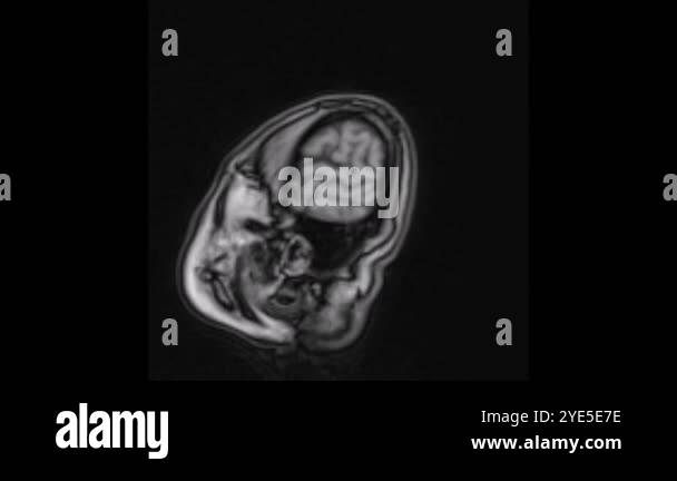 Sagittal T1-weighted image magnetic resonance imaging (MRI) scan of a ...