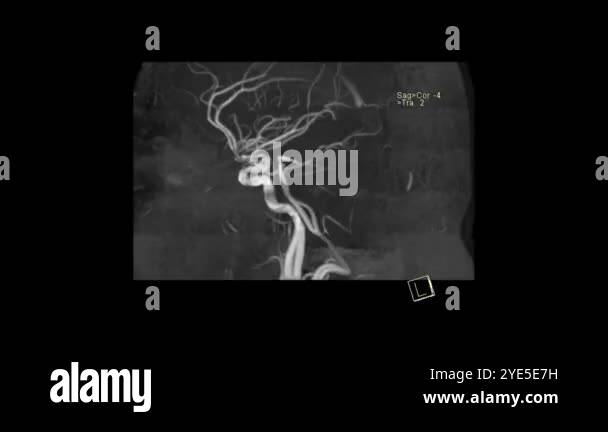 3D time of flight (TOF) sequence magnetic resonance imaging (MRI) scan ...