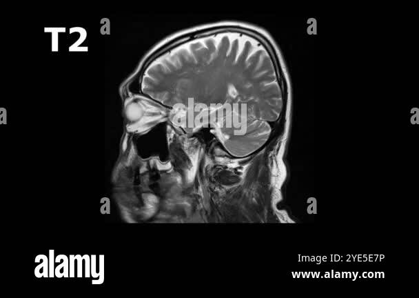 T2-weighed magnetic resonance imaging (MRI) scan of a healthy skull and ...