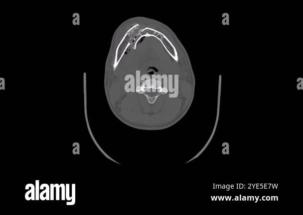 Computed tomography (CT) scan Image of a hyoid (tongue bone) and jaw ...