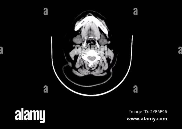 Computed tomography (CT) scan of the brain of a patient with a ...
