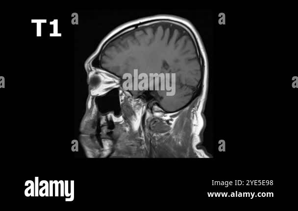 T1-weighed magnetic resonance imaging (MRI) scan of a healthy skull and ...