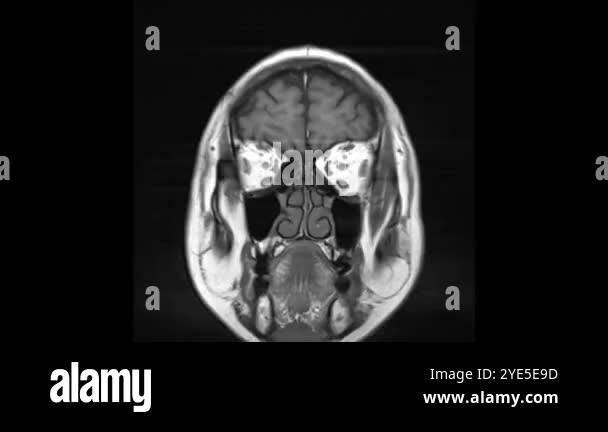 Coronal T1-weighted magnetic resonance imaging (MRI) scan of a normal ...