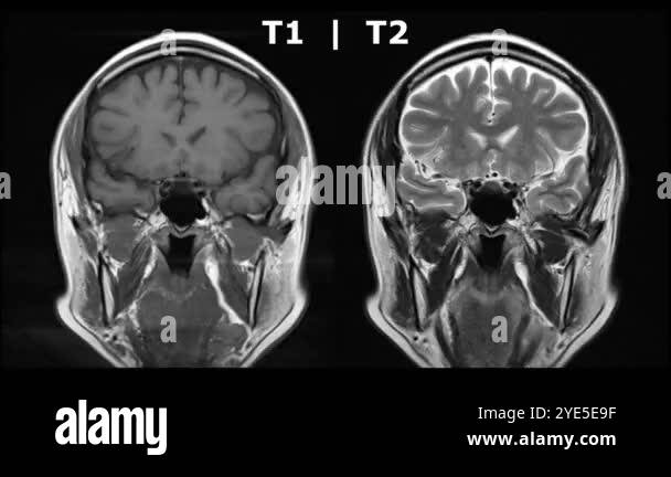 T1 weighted mri Stock Videos & Footage - HD and 4K Video Clips - Alamy