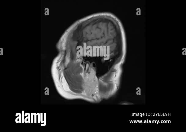 Sagittal T1-weighted magnetic resonance imaging (MRI) scan of a normal brain Stock Video Footage ...