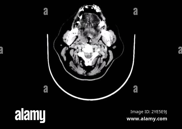 Computed tomography (CT) scan of a 65-year-old woman's brain following ...