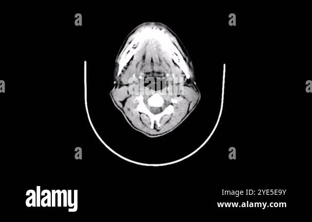 Computed tomography (CT) scan of an 18-year-old man with ...