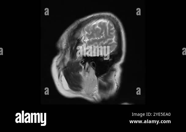 Sagittal T2-weighted magnetic resonance imaging (MRI) scan of a normal brain Stock Video Footage ...