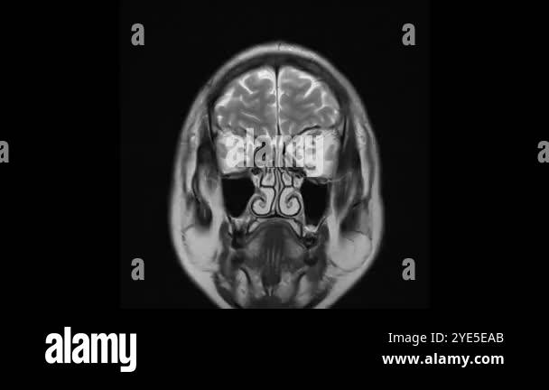 Coronal T2-weighted magnetic resonance imaging (MRI) scan of a normal brain Stock Video Footage ...