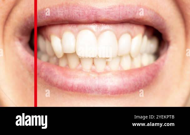 Girl's teeth before and after retouching, example, close-up of teeth ...