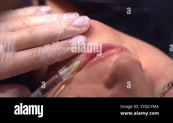 Beautician doctor makes botulinum toxin injection in the lips of young ...