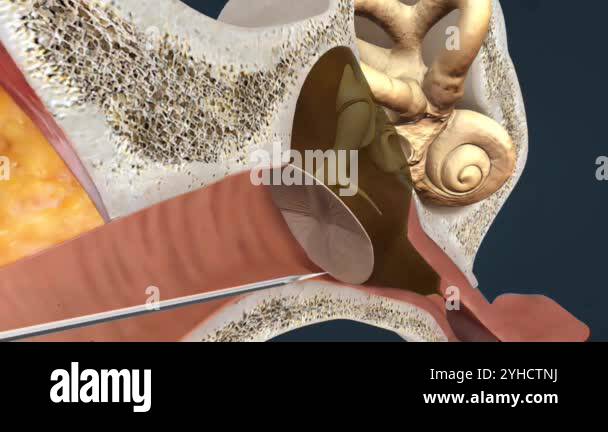 Paracentesis of the eardrum, or tympanocentesis, is a medical procedure ...