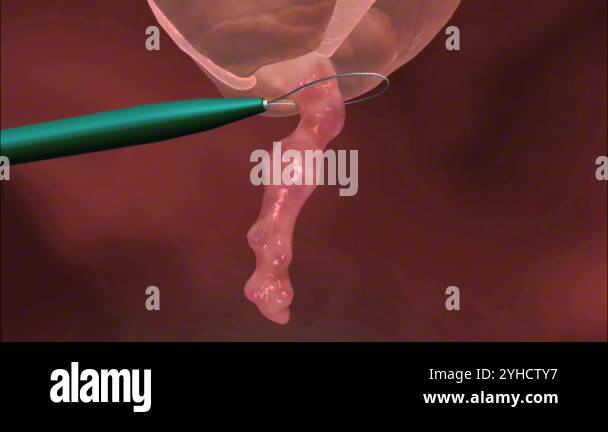 Surgical anesthesia history Stock Videos & Footage - HD and 4K Video ...