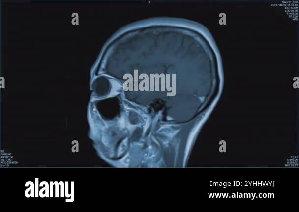 Magnetic resonance images of the brain, MRI of the brain, of a patient ...