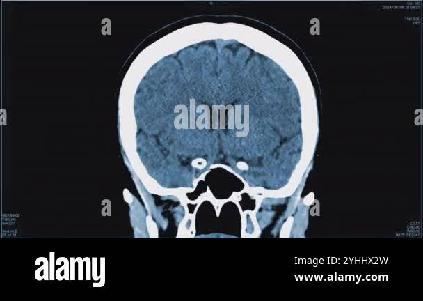 Magnetic resonance images of the brain, MRI of the brain, of a patient ...