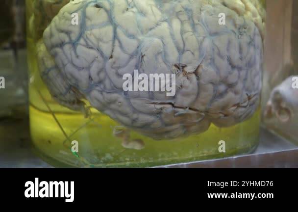 Real human brain, grey matter. Human brain in glass jar with ...