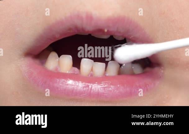 Doctor loosens teeth with cotton bud. Five year old boy at dentist ...