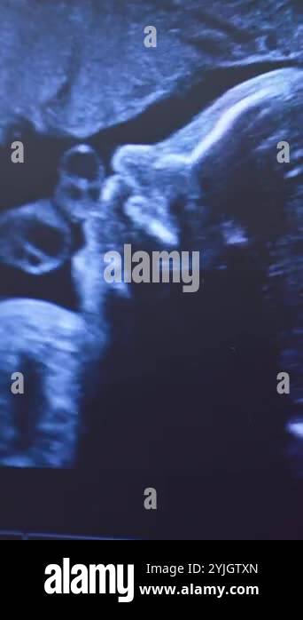 Screen shows a future child on ultrasonography. Baby during ultrasound ...