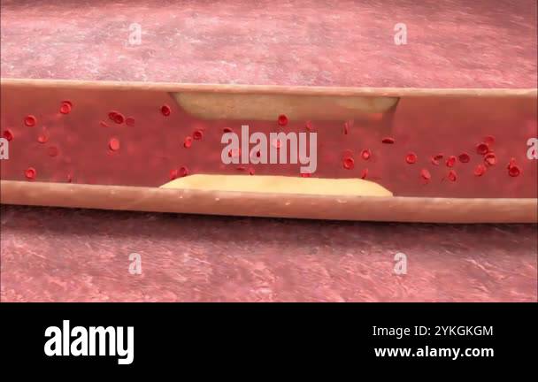 Blocked blood flow Stock Videos & Footage - HD and 4K Video Clips - Alamy