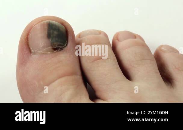 Bruise under the nail of big toe. Trauma of toenail. Subungual hematoma ...