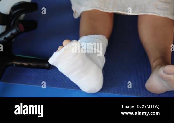Broken foot in plaster Stock Videos & Footage - HD and 4K Video Clips ...