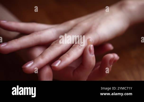 Close up blister with stretched skin on finger. Woman touches large ...