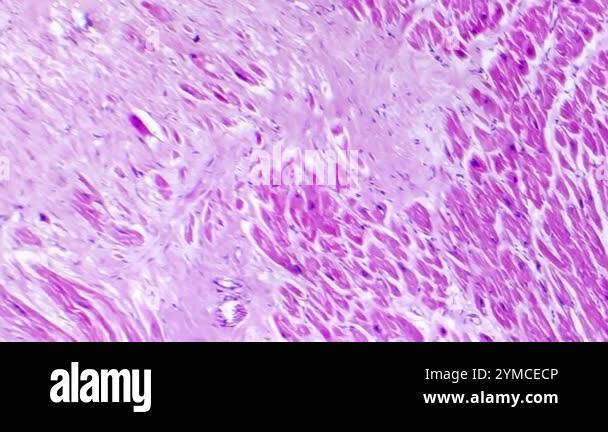 Myocardial infarction, light microscopy showing damaged heart tissue ...