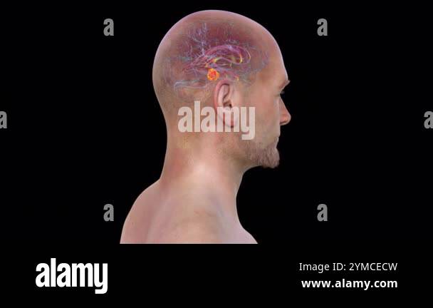 A 3D scientific animation depicting enlarged lateral and third ...