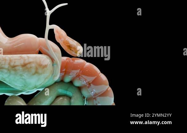 Gallstones in the gallbladderand bile duct, human silhouette and ...