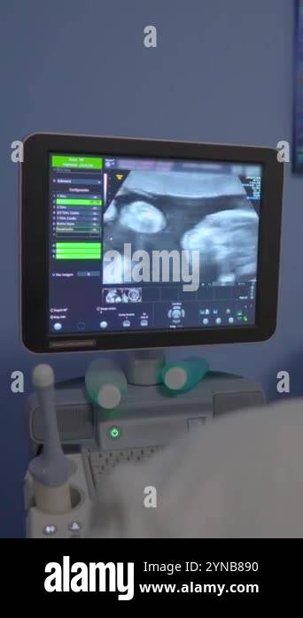 Ultrasound machine screen displaying a baby in the late stages of ...