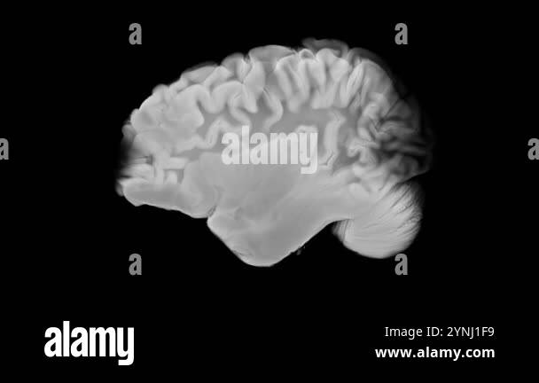 Sagittal cross-section of a human brain affected by an ischemic stroke ...
